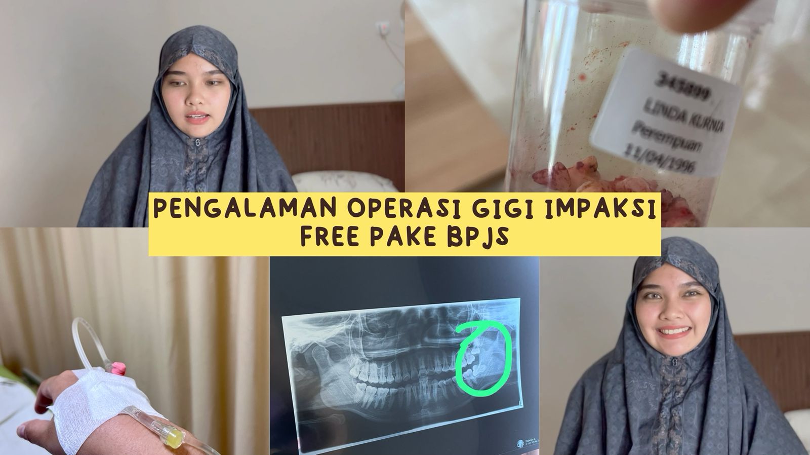 PENGALAMAN OPERASI 4 GIGI IMPAKSI (FREE) FULL COVER BPJS DI RS BEKASI ...