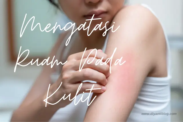 Ruam Kulit Setelah Liburan? Ini Cara Ampuh Mengatasinya! | Blogger ...